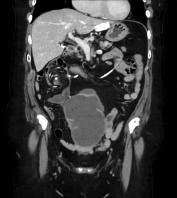 Cecal volvulus, a rare and late complication of a laparoscopic ...