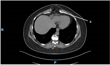Laparoscopic repair for a recurrent epigastric incisional hernia ...