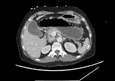 Concurrent presentation of unrelated perforated appendicitis and high ...
