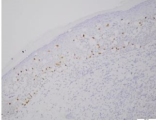 Perianal Paget’s disease regression after treatment for triple negative ...