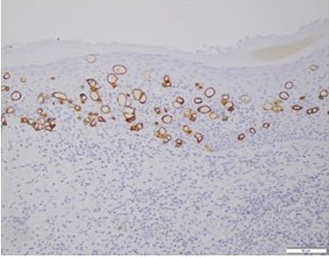 Perianal Paget’s disease regression after treatment for triple negative ...