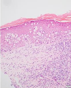 Perianal Paget’s disease regression after treatment for triple negative ...